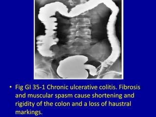 35 narrowing of the colon | PPTX