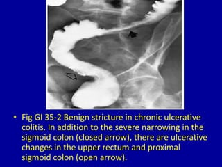 35 narrowing of the colon | PPTX