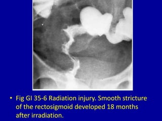 35 narrowing of the colon | PPTX