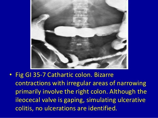35 narrowing of the colon