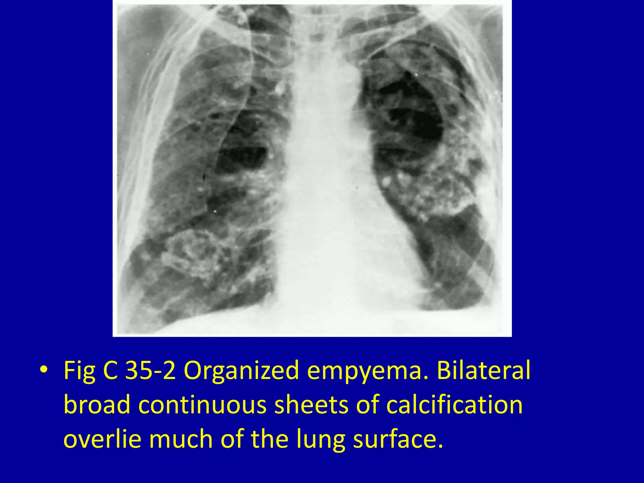 35 pleural calcification | PPTX