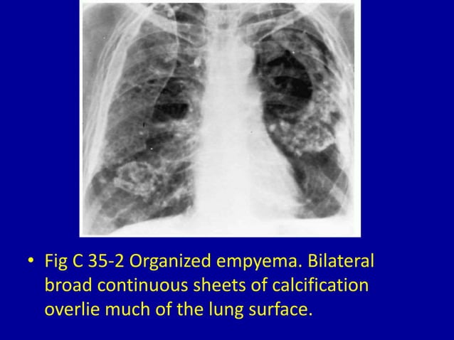 35 pleural calcification | PPT