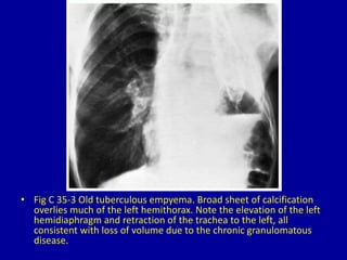 35 pleural calcification | PPT