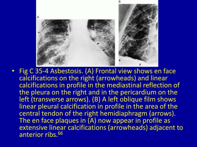 35 pleural calcification | PPT