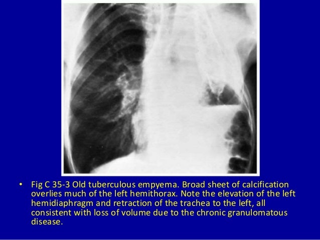 Pleural Calcifications , Pleural effusion: diagnosis, treatment, and ...