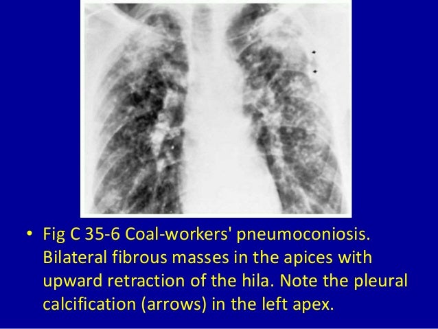 Pleural Calcifications , Pleural effusion: diagnosis, treatment, and ...