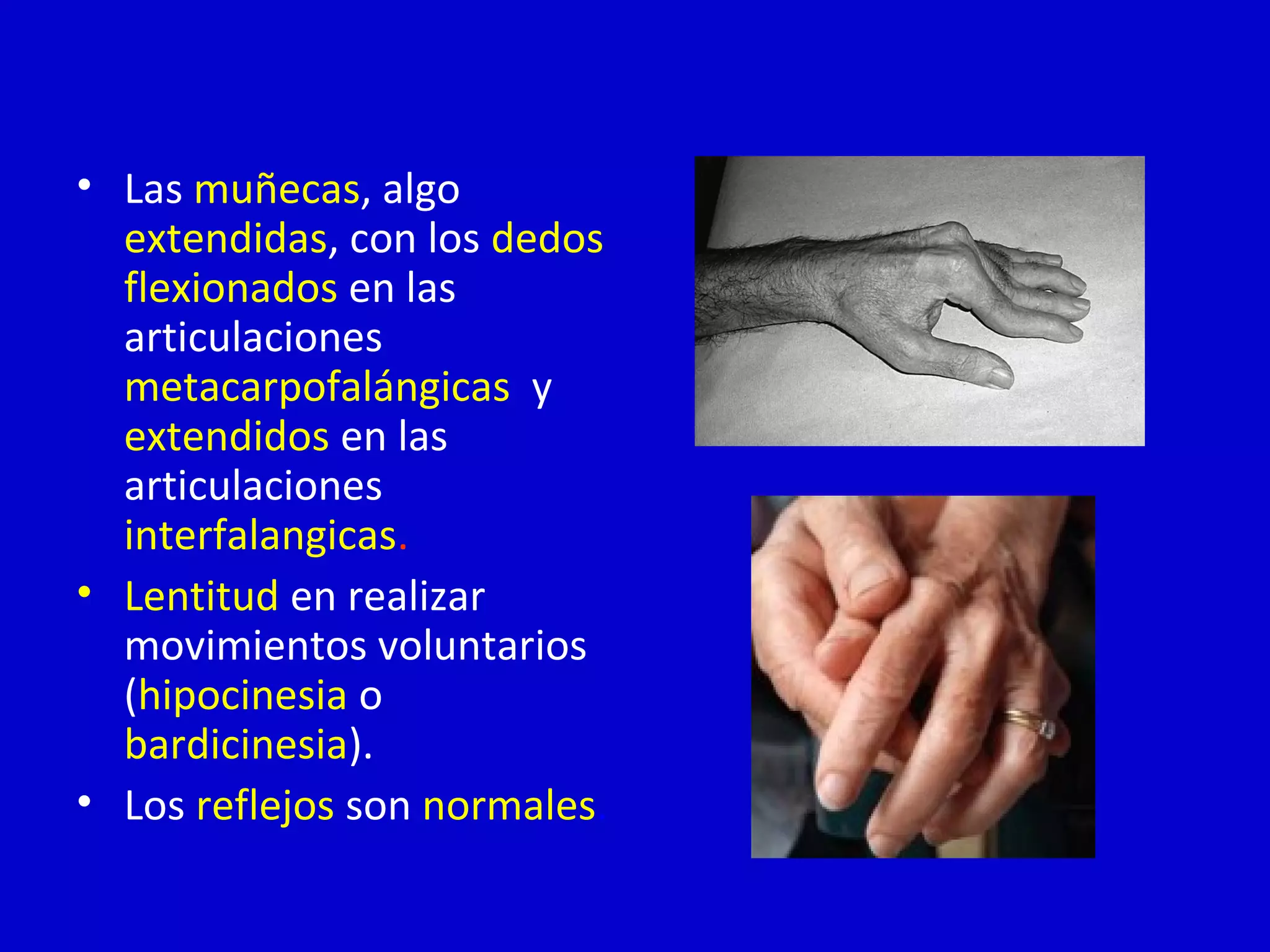 Síndrome extrapiramidal | PPT | Brain and Nervous System Disorders ...