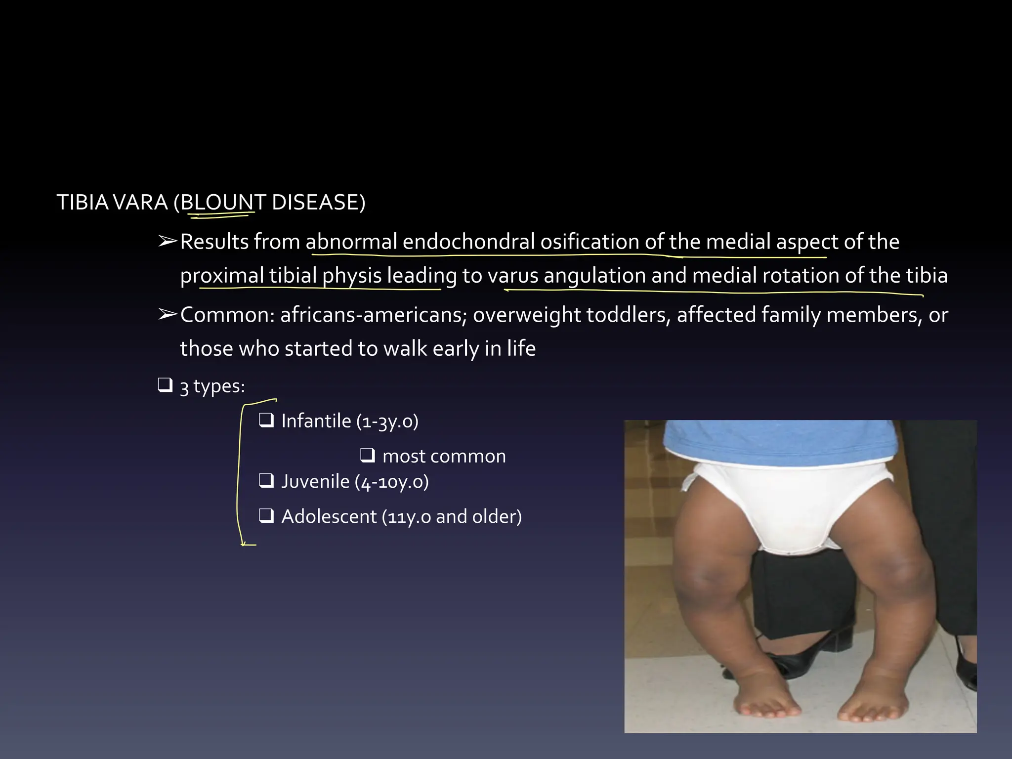 36. BONES AND JOINTS DISORDER pediatrics | PDF