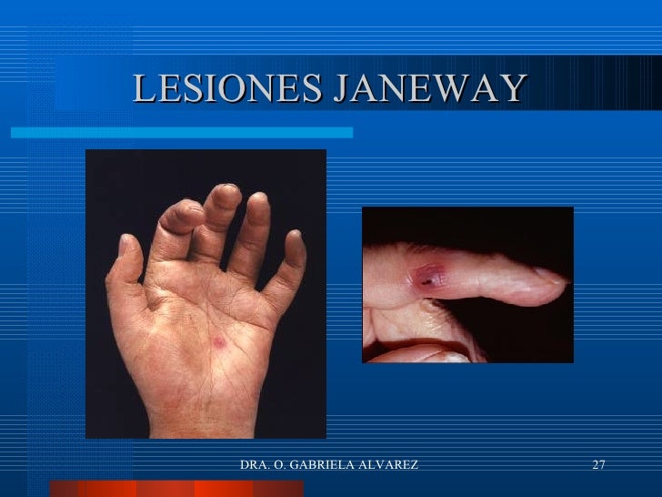 36. )Endocarditis Y Fiebre ReumáTica