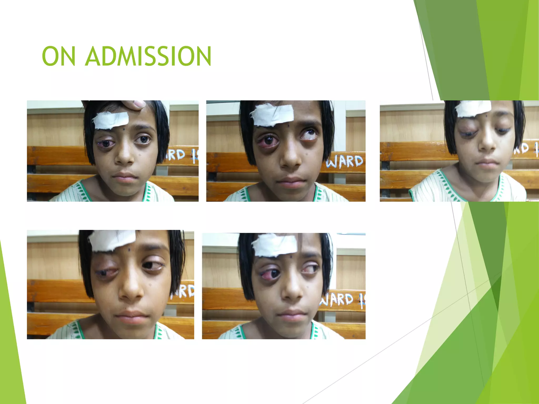 Orbital Hemorrhage Following Trivial Trauma | PPT