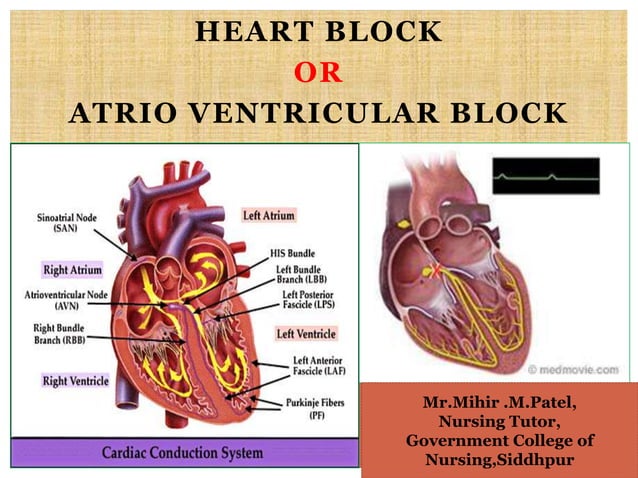 361711208-Heart-Block-ppt.pptx