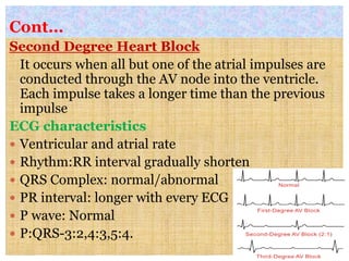 361711208-Heart-Block-ppt.pptx