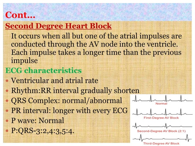 361711208-Heart-Block-ppt.pptx