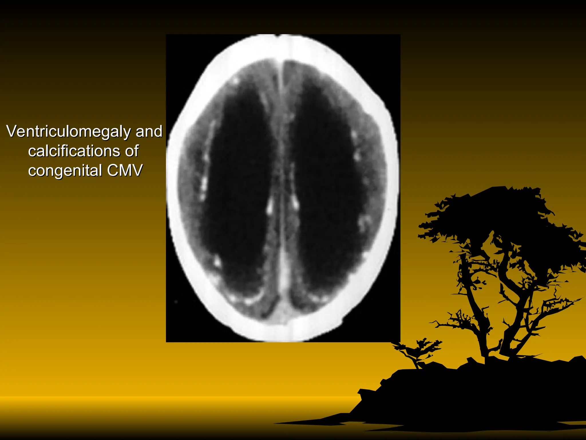 -Torch-Infection-Easier model for starters.ppt