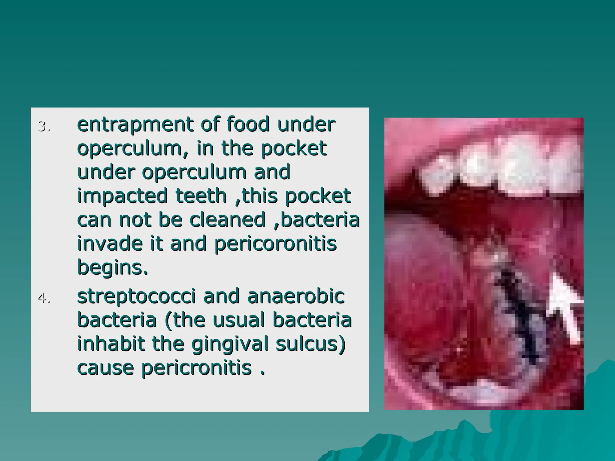 mandibular impacted teeth in maxillofacial surgery | PPT
