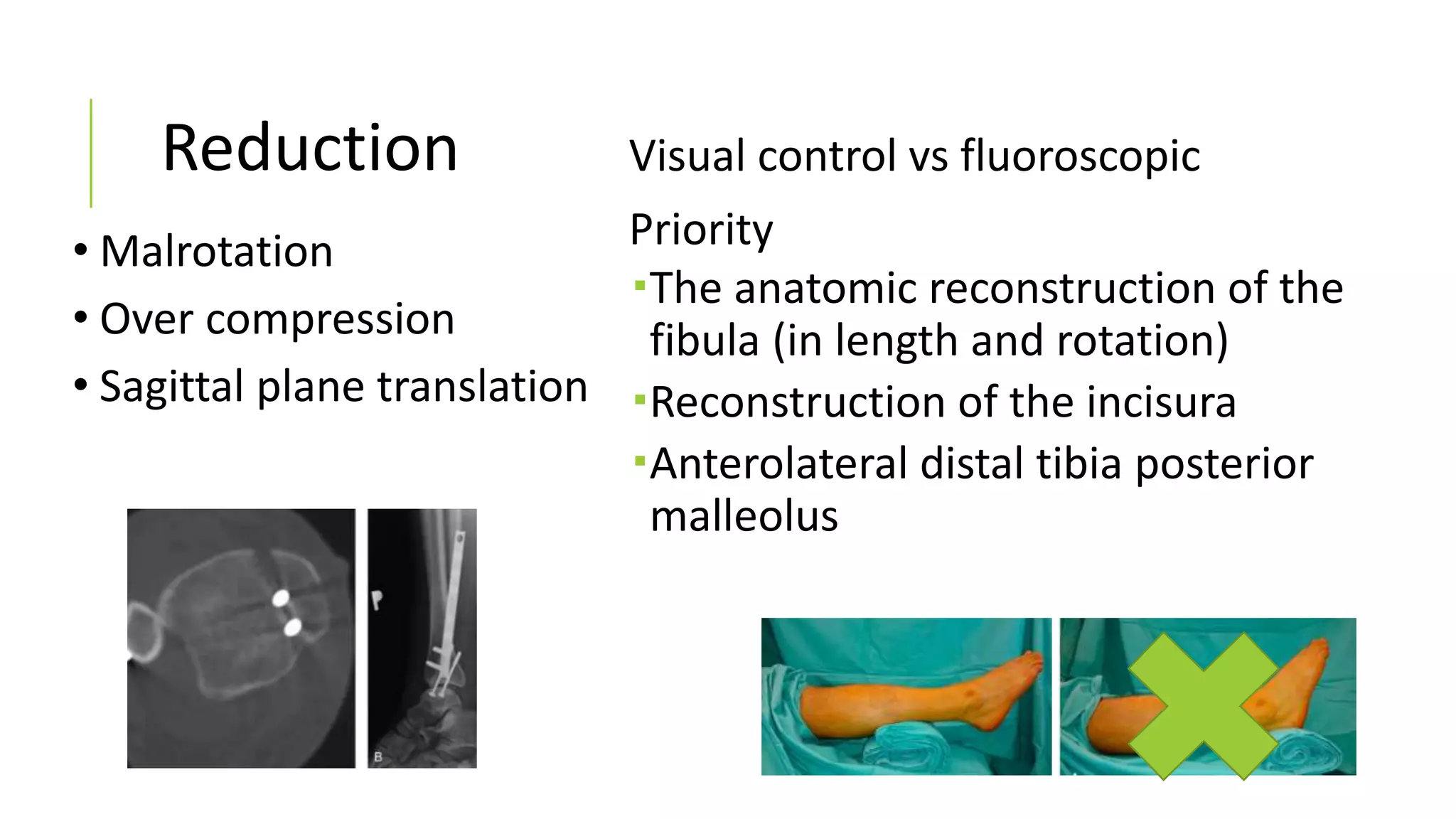 Ankle fracture : Syndesmosis Injury | PPTX