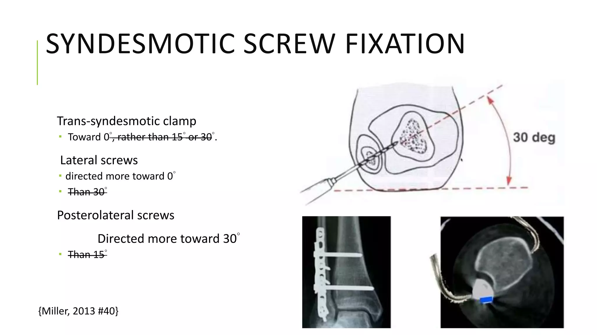 Ankle fracture : Syndesmosis Injury | PPTX