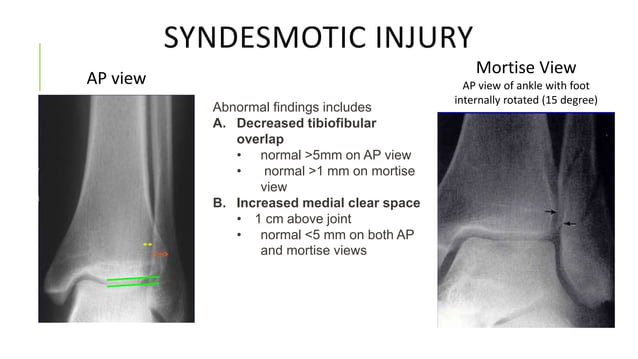 Ankle fracture : Syndesmosis Injury | PPTX