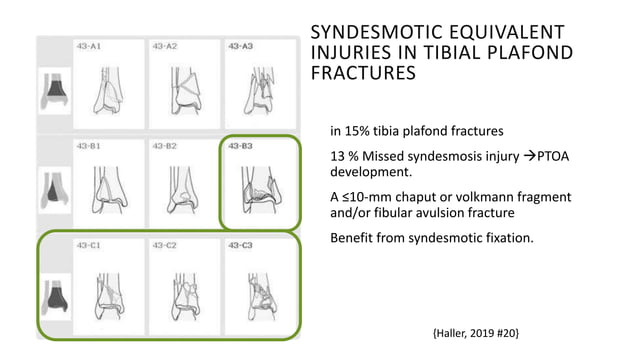 Ankle fracture : Syndesmosis Injury | PPTX
