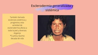PIEL Y ESCLERODERMIA | PPT