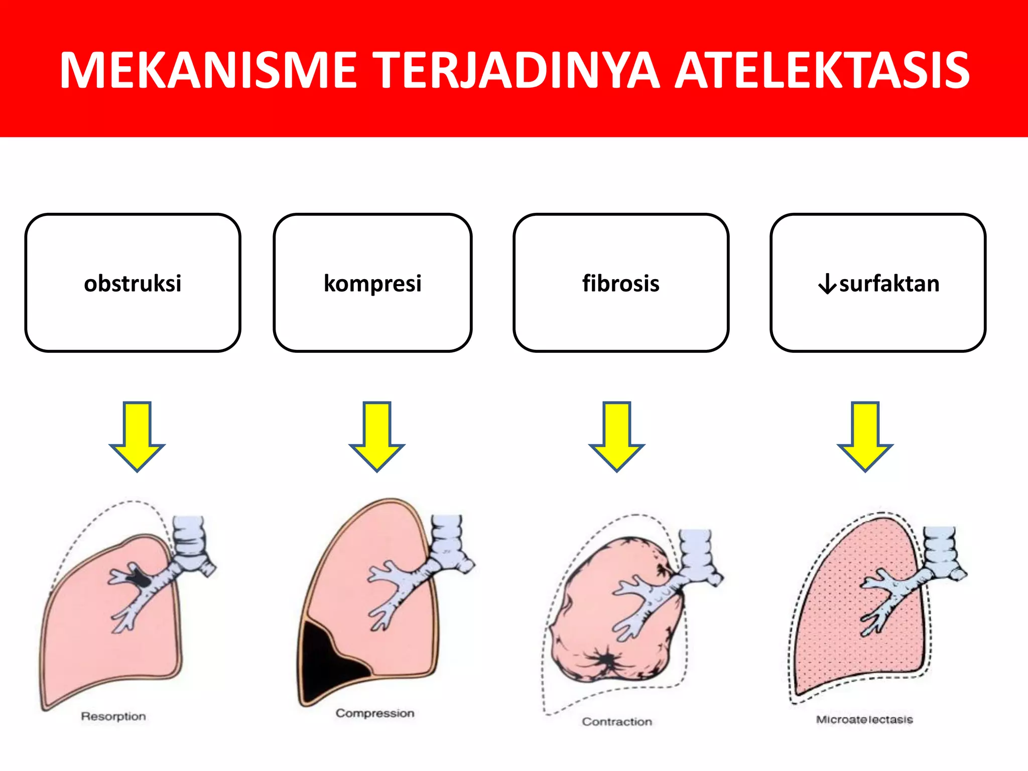 366117275-4-ATELEKTASIS.pdf