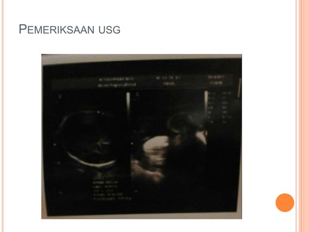 366350342-LAPORAN-KASUS-OBGYN-PPT-pptx.pptx