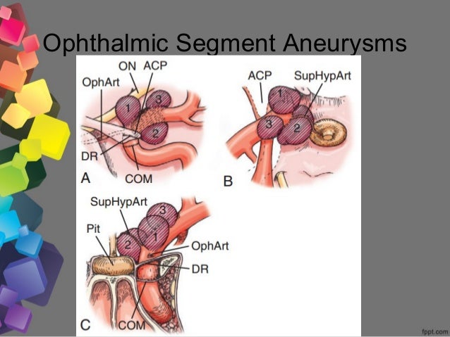 366 Microsurgery of paraclinoid aneurysm