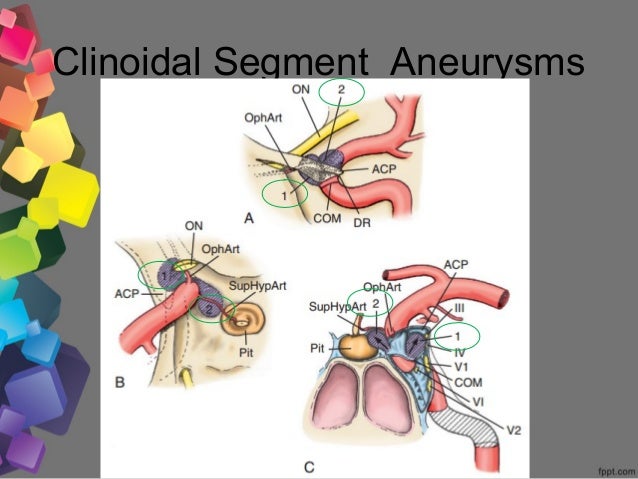 366 Microsurgery of paraclinoid aneurysm