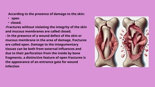General Medicine, General Surgery. Fractures | PPTX