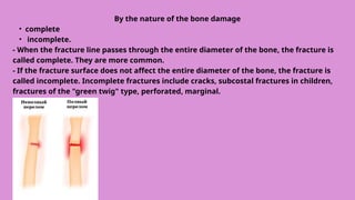 General Medicine, General Surgery. Fractures | PPTX