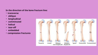 General Medicine, General Surgery. Fractures | PPTX