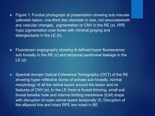 A Case Of Mac Tel 2 With An Unusual Sub Macular Vitelliform Lesion | PPTX