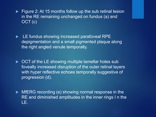 A Case Of Mac Tel 2 With An Unusual Sub Macular Vitelliform Lesion | PPTX