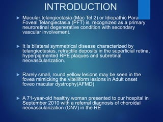 A Case Of Mac Tel 2 With An Unusual Sub Macular Vitelliform Lesion | PPT