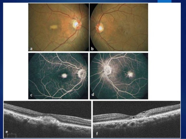 A Case Of Mac Tel 2 With An Unusual Sub Macular Vitelliform Lesion