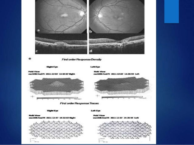 A Case Of Mac Tel 2 With An Unusual Sub Macular Vitelliform Lesion