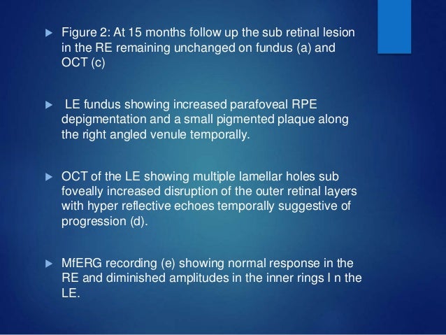 A Case Of Mac Tel 2 With An Unusual Sub Macular Vitelliform Lesion
