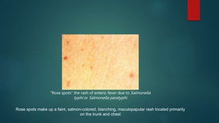 369683513-Typhoid-Feverbh the besth.pptx