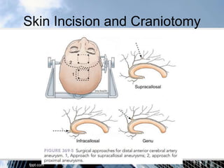 369 Microsurgery of DACA | PPTX