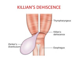 Killians Dehiscence