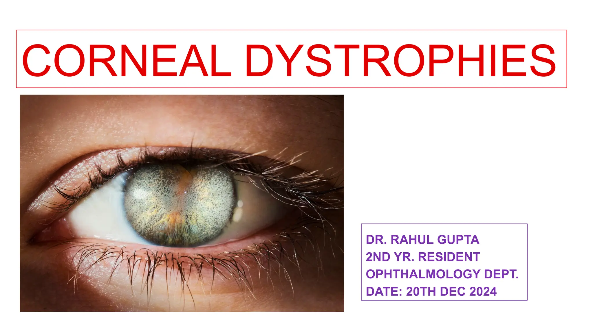 36 Corneal Dystrophies by Dr. Rahul.pptx