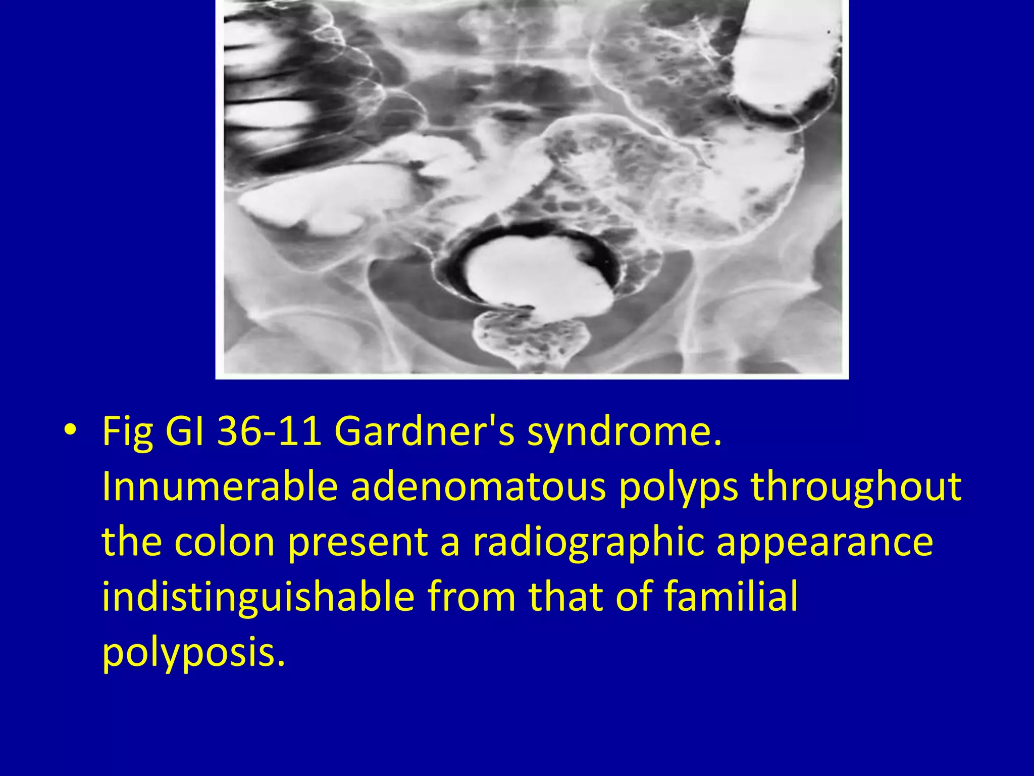36 filling defects in the colon | PPTX