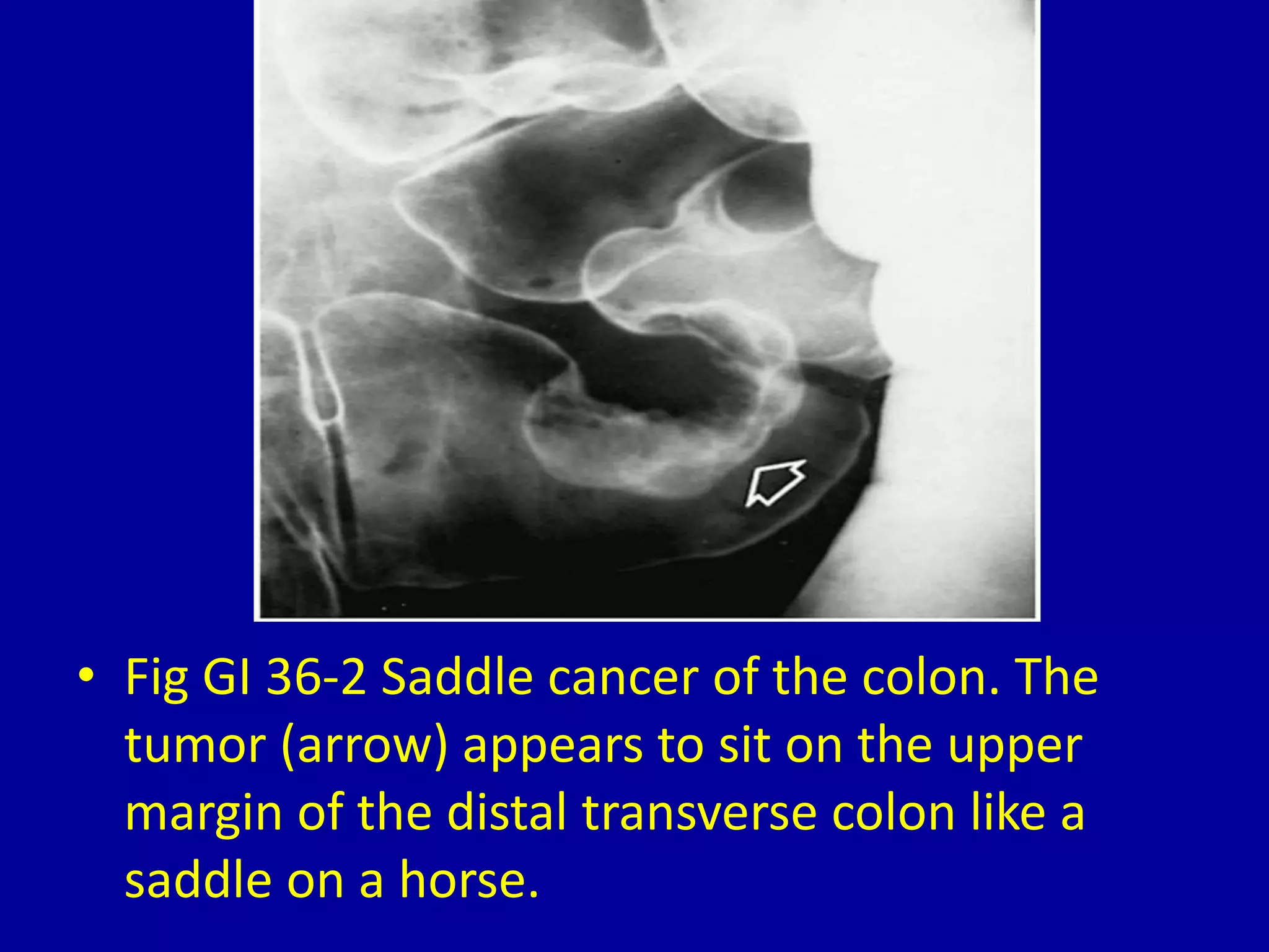 36 filling defects in the colon | PPTX