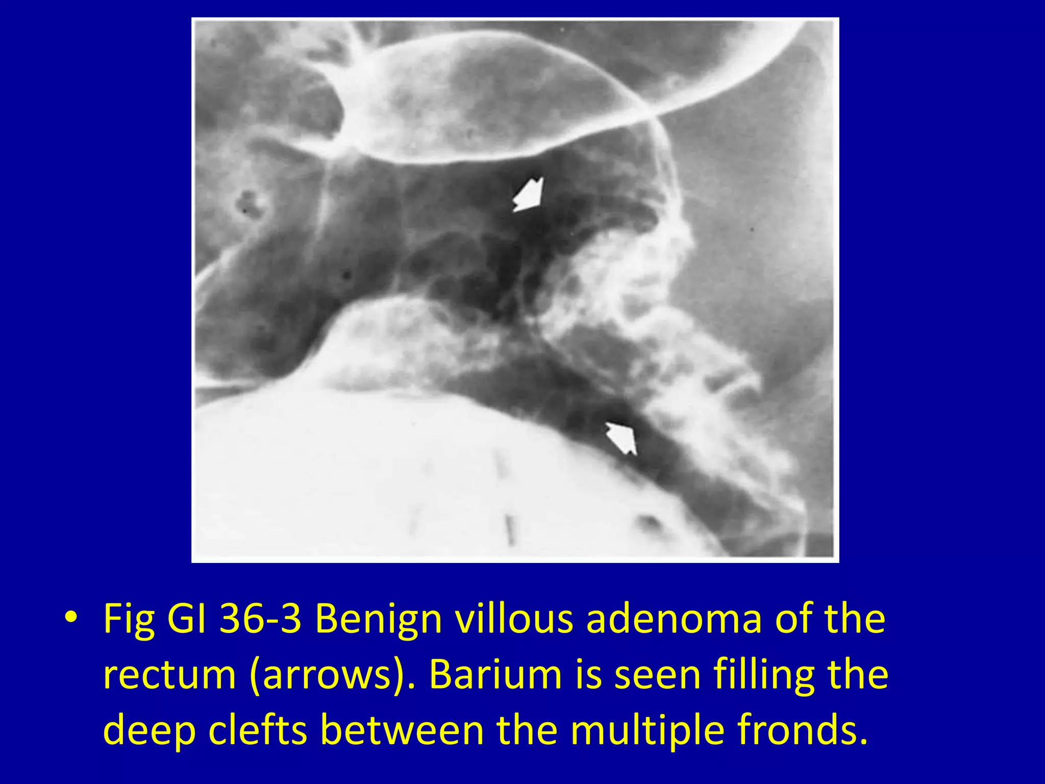 36 filling defects in the colon | PPTX
