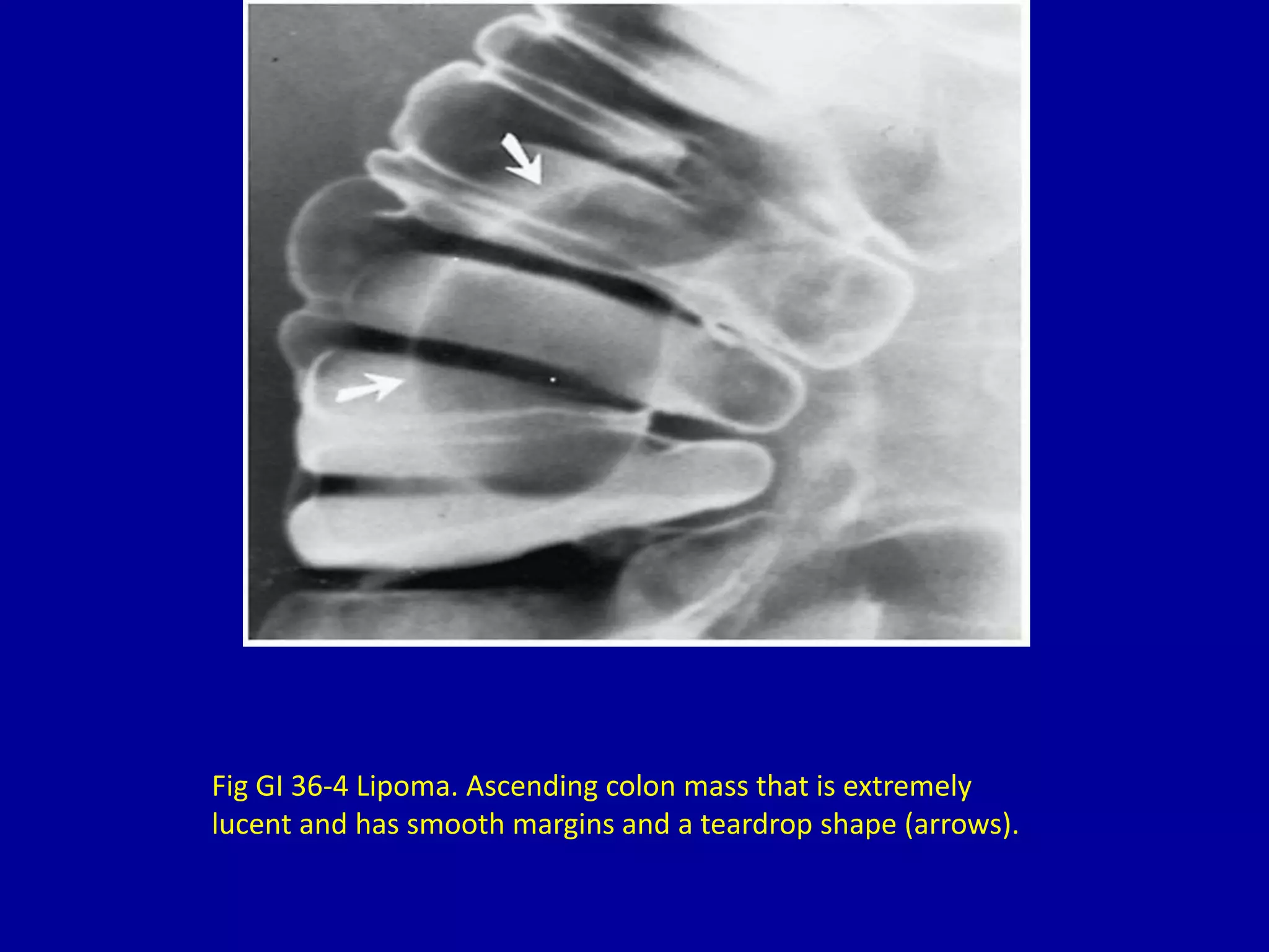 36 filling defects in the colon | PPTX