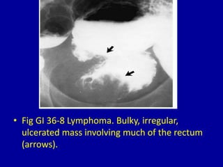 36 filling defects in the colon | PPTX