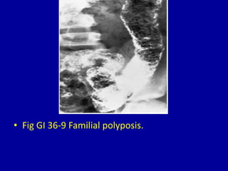 36 filling defects in the colon | PPTX | Digestive Disorders | Diseases ...