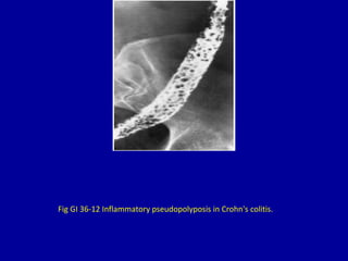 36 filling defects in the colon | PPTX | Digestive Disorders | Diseases ...