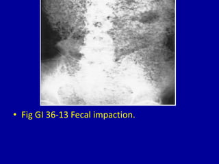 36 filling defects in the colon | PPTX