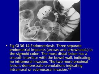 36 filling defects in the colon | PPTX | Digestive Disorders | Diseases ...